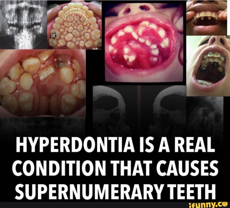Hyperdontia Causes