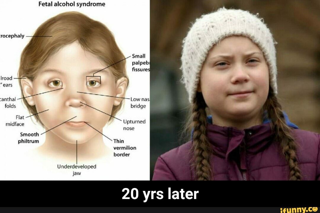 Fetal alcohol syndrome Small 'anthal folds bridge Flat midface Upturned ...