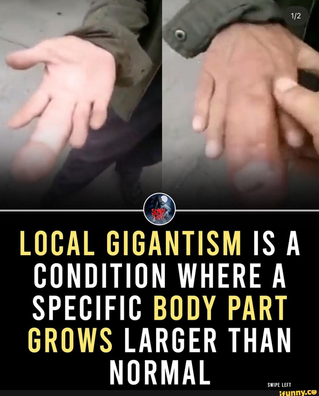 LOCAL GIGANTISM IS A CONDITION WHERE A SPECIFIC BODY PART GROWS LARGER ...