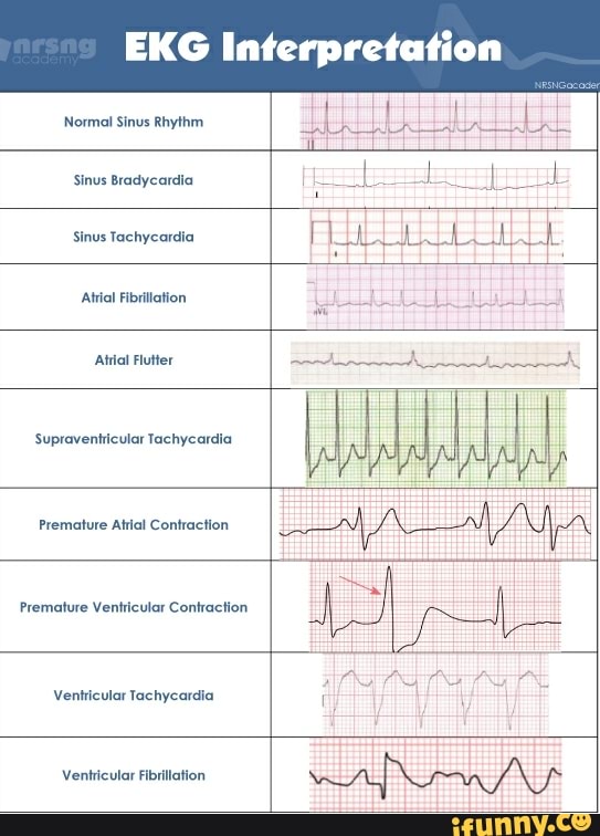 EKG Interpretation Normal Sinus Rhythm, Sinus Bradycardia Sinus ...