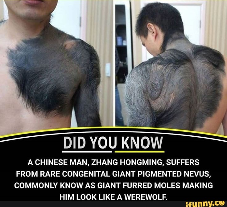 DID YOU KNOW A CHINESE MAN, ZHANG HONGMING, SUFFERS FROM RARE ...