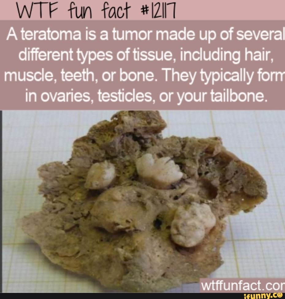 WTF fun fact A teratoma is a tumor mace up of several different types ...