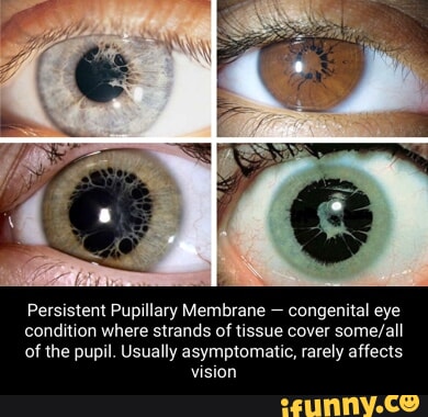 Persistent Pupillary Membrane - congenital eye condition where strands ...